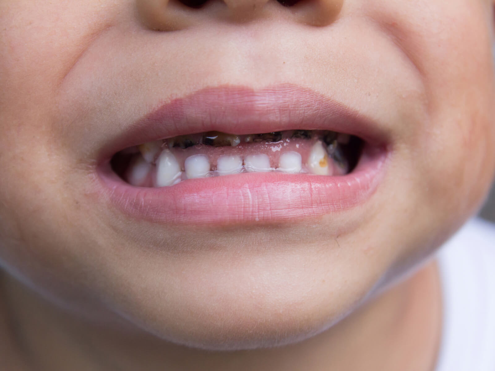 The Stages of Tooth Decay: What You Should Know